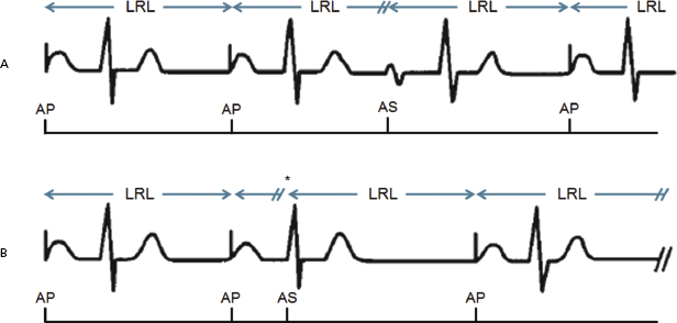 6: Pacemaker Timing Cycles and Special Features | Thoracic Key