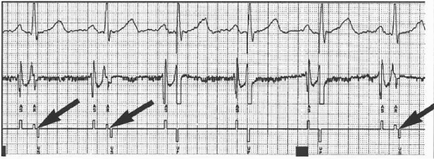 6: Pacemaker Timing Cycles and Special Features | Thoracic Key
