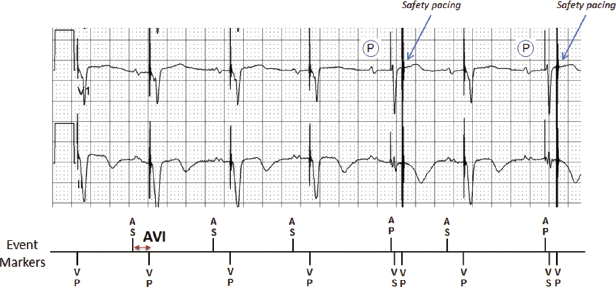 6: Pacemaker Timing Cycles and Special Features | Thoracic Key