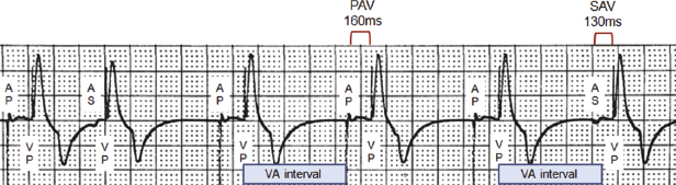 6: Pacemaker Timing Cycles and Special Features | Thoracic Key