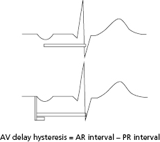 6: Pacemaker Timing Cycles and Special Features | Thoracic Key