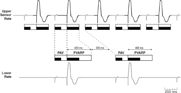 6: Pacemaker Timing Cycles and Special Features | Thoracic Key