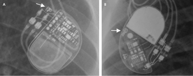 7: Evaluation, Troubleshooting, and Management of Pacing System ...