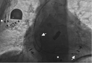 7: Evaluation, Troubleshooting, and Management of Pacing System ...