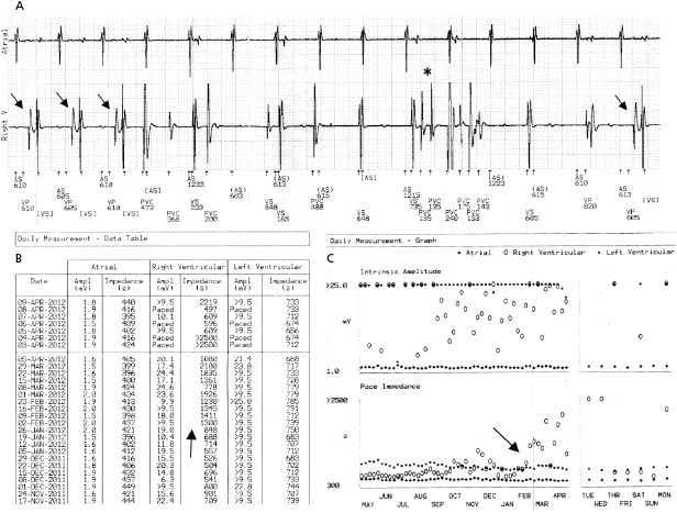 7: Evaluation, Troubleshooting, and Management of Pacing System ...