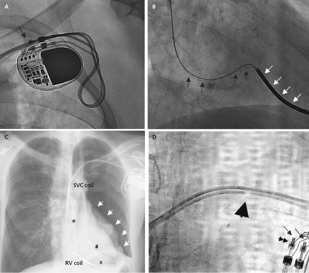 7: Evaluation, Troubleshooting, and Management of Pacing System ...