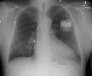 8: The Implantable Cardioverter–Defibrillator | Thoracic Key