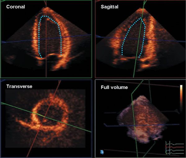 Quantitative Methods in Echocardiography—Advanced Techniques for the ...