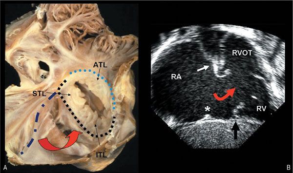 Ebstein’s Malformation and Tricuspid Valve Diseases | Thoracic Key