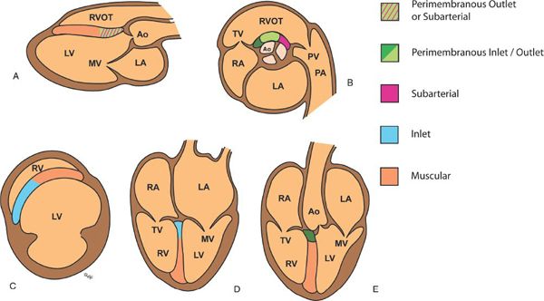 Ventricular Septal Defects Thoracic Key