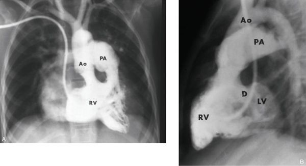 Double-Outlet Right and Left Ventricles | Thoracic Key