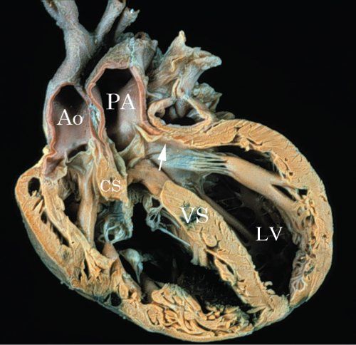 Double-Outlet Right and Left Ventricles | Thoracic Key