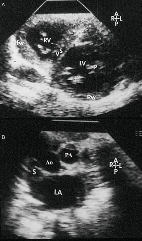 Double-Outlet Right and Left Ventricles | Thoracic Key