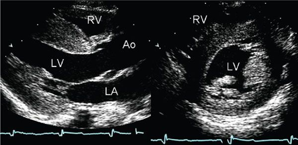 Hypertrophic Cardiomyopathy | Thoracic Key