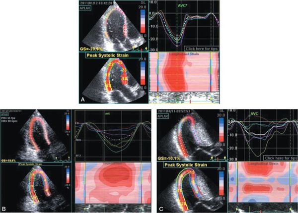 Hypertrophic Cardiomyopathy | Thoracic Key