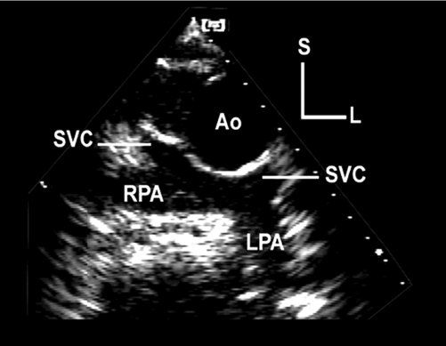 Echocardiographic Evaluation Of The Functionally Univentricular Heart