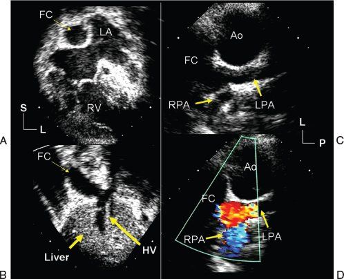 Echocardiographic Evaluation of the Functionally Univentricular Heart ...