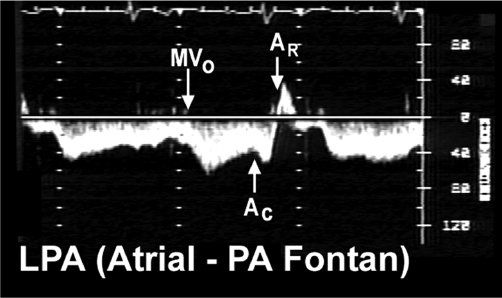 Echocardiographic Evaluation of the Functionally Univentricular Heart ...