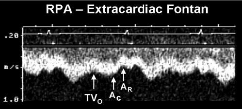 Echocardiographic Evaluation of the Functionally Univentricular Heart ...