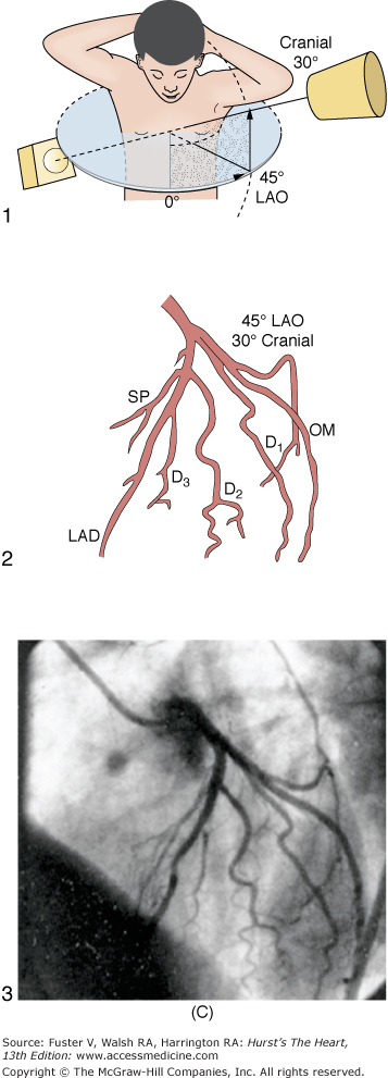 Cardiac Catheterization, Cardiac Angiography, and Coronary Blood Flow ...