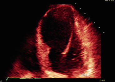 The S3 Gallop | Thoracic Key