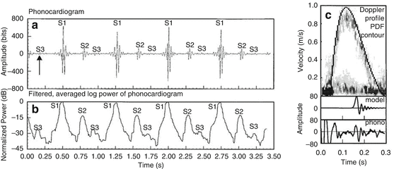 The S3 Gallop | Thoracic Key
