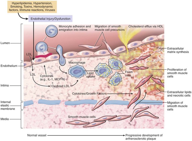 Acute Coronary Syndromes | Thoracic Key