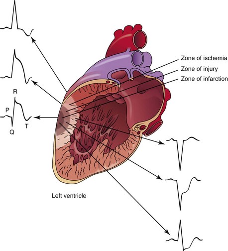 Acute Coronary Syndromes | Thoracic Key