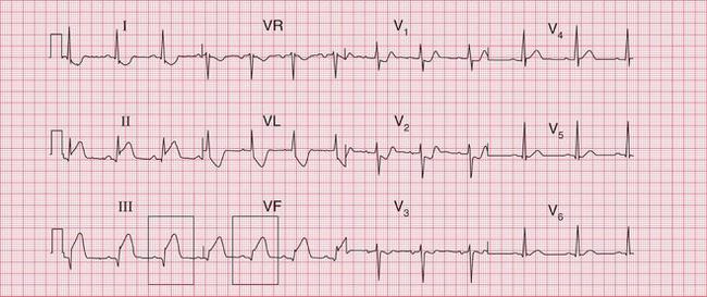 The ECG in Patients with Chest Pain | Thoracic Key