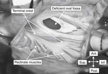 Surgical Anatomy of the Heart | Thoracic Key
