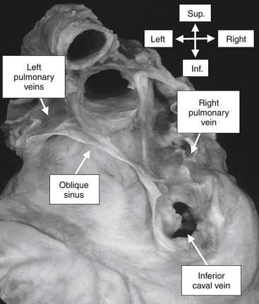 Surgical Anatomy of the Heart | Thoracic Key