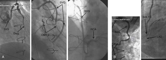 Coronary Angiography: Valve and Hemodynamic Assessment | Thoracic Key