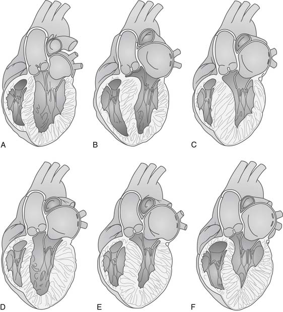 Surgical Management of Hypertrophic Cardiomyopathy | Thoracic Key