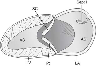 Atrioventricular Canal Defects | Thoracic Key