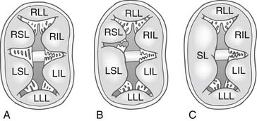 Atrioventricular Canal Defects | Thoracic Key