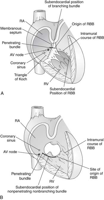 Atrioventricular Canal Defects | Thoracic Key