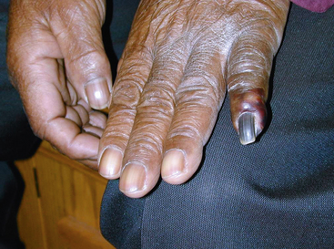 Atheroembolism | Thoracic Key