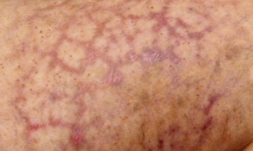 Atheroembolism | Thoracic Key