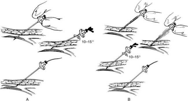 Arterial Access; Guidewires, Catheters, and Sheaths; and Balloon ...