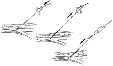 Arterial Access; Guidewires, Catheters, and Sheaths; and Balloon ...
