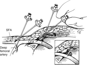 Arterial Access; Guidewires, Catheters, and Sheaths; and Balloon ...