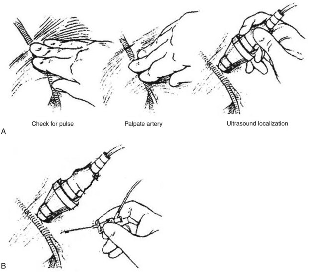 Arterial Access; Guidewires, Catheters, and Sheaths; and Balloon ...
