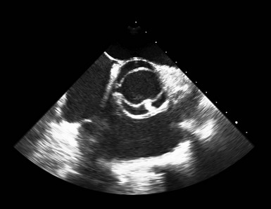 The Bicuspid Aortic Valve and Associated Aortic Disease | Thoracic Key