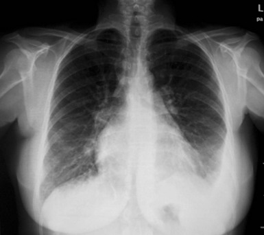 Rheumatic Mitral Valve Disease | Thoracic Key