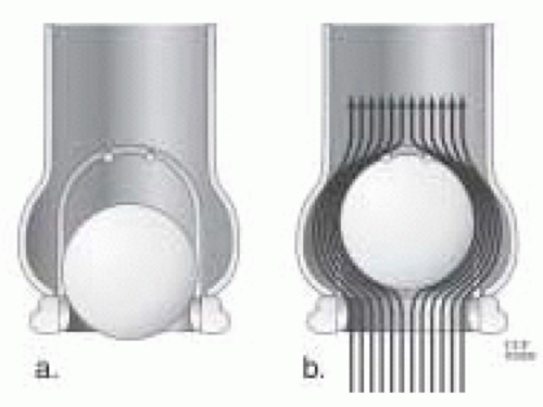 Assessment of Prosthetic Valves | Thoracic Key