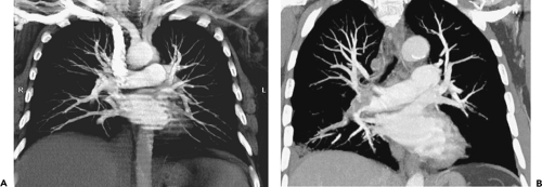 Pulmonary Arterial Disease | Thoracic Key