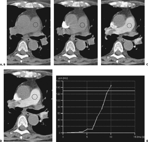 Pulmonary Arterial Disease | Thoracic Key