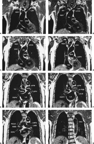 Mediastinum | Thoracic Key