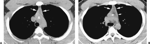 Mediastinum | Thoracic Key