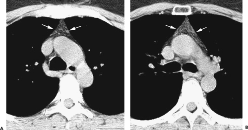 Mediastinum | Thoracic Key
